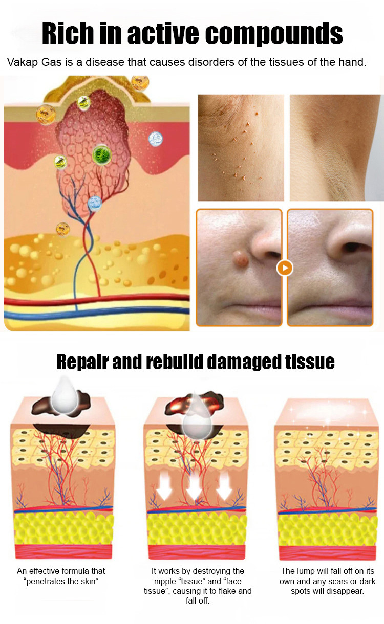 144pcs/box Wart Remover Patch/Wart Skin Tag Remover/Callus Corns ...