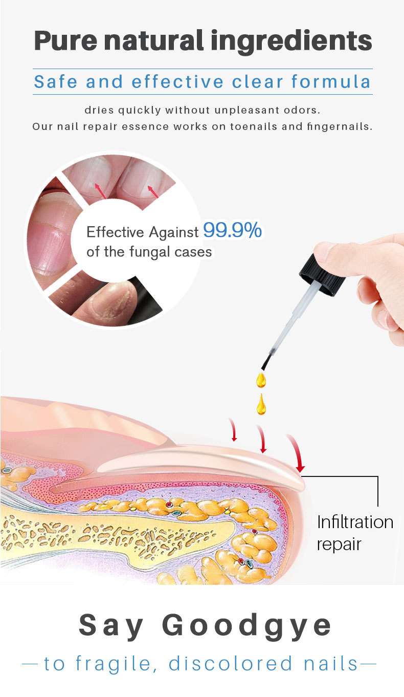 LANTHOME Penjagaan Kuku - Nail Fungus Treatment Untuk Kuku Jamur ...