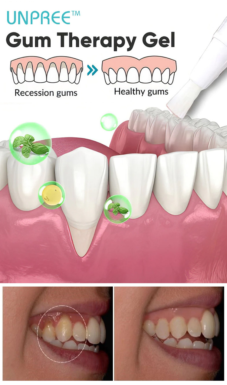 Restoration of tooth enamel Repair Gel Firmly brushed teeth Restore gum ...