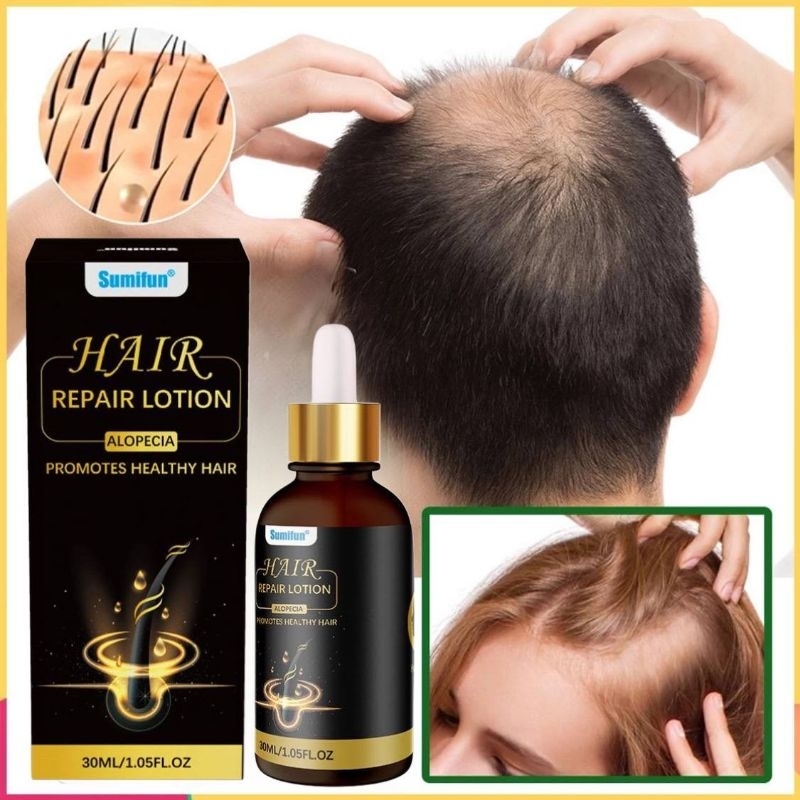 HAIR REPAIR LOTION ALOPECIA Penjagaan rambut gugur dan kebotakan kepala ...