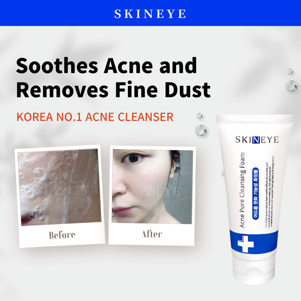 [SKINEYE] AC Pure Cleansing Foam - 120ml, Korean Pimple Cystic Acne ...