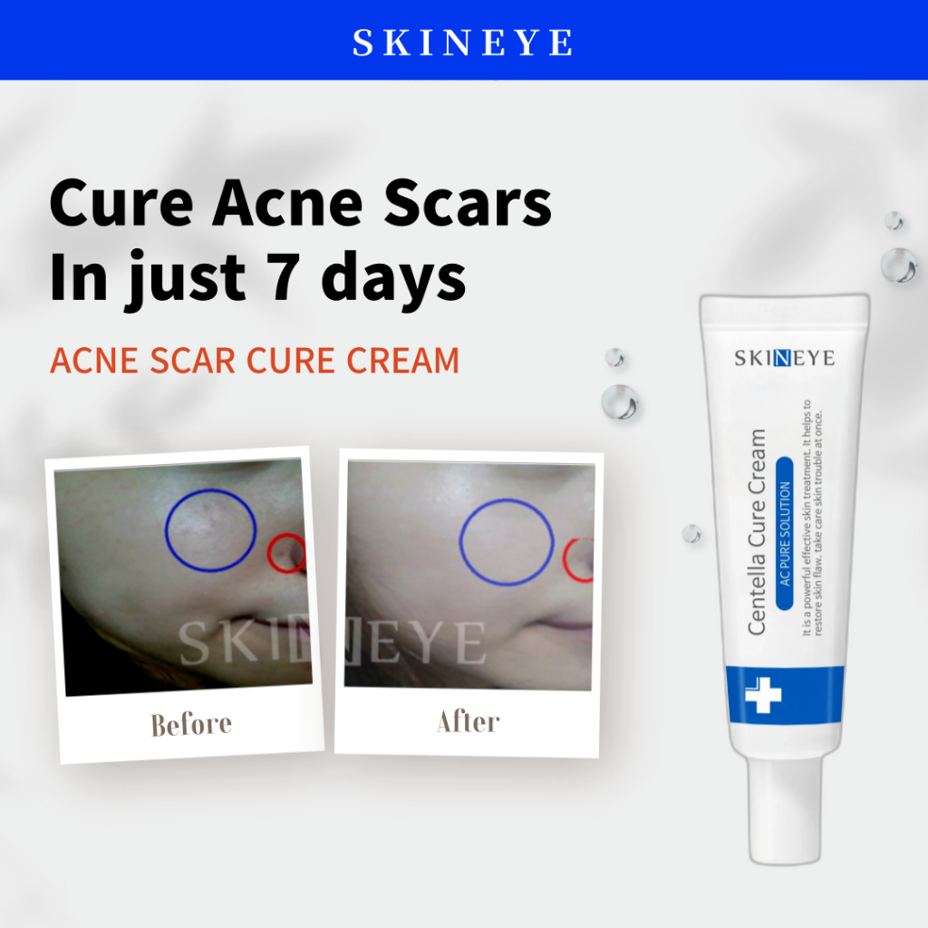 [SKINEYE] AC Pure Centella Cure Cream - 20ml, Korean Pimple Acne Scar ...