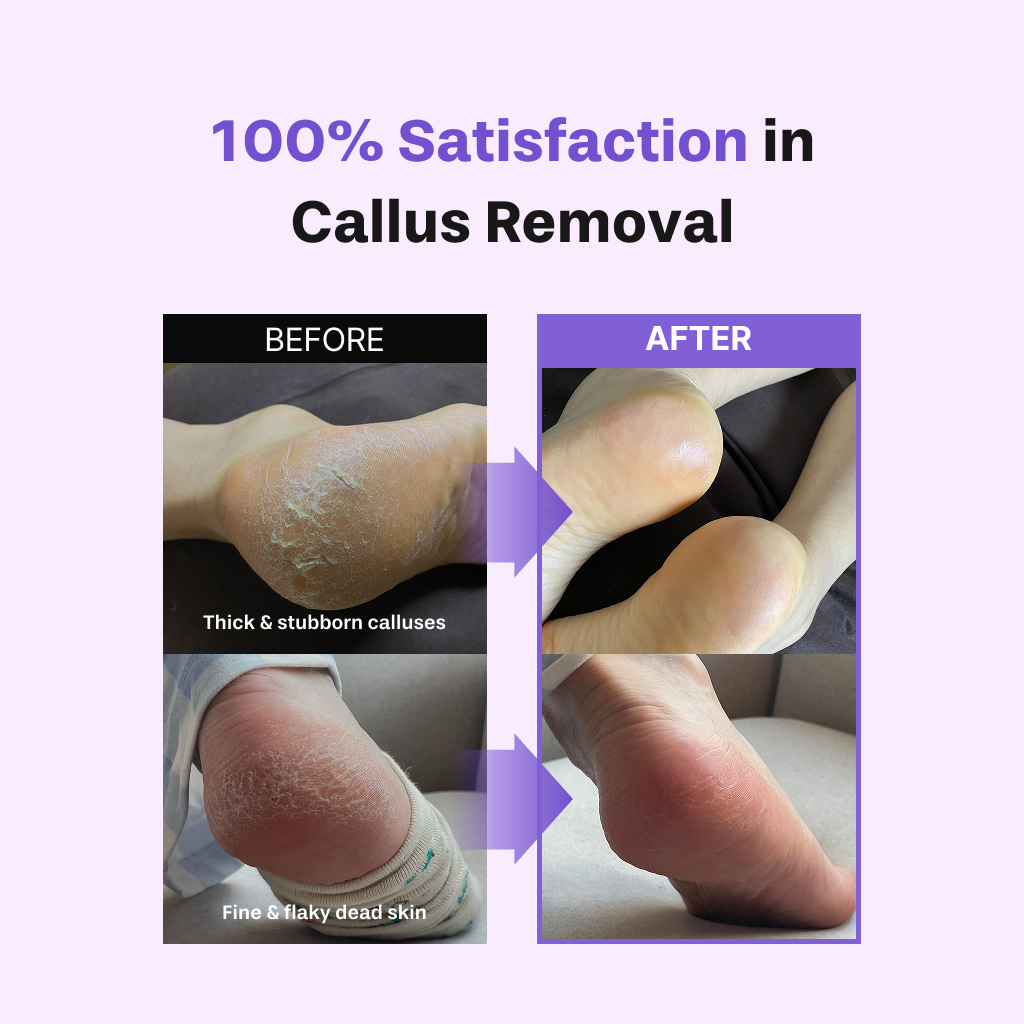 [BEST] BAREN 1-Minute Callus Remover Kit for Feet: Foot File & Peeling ...
