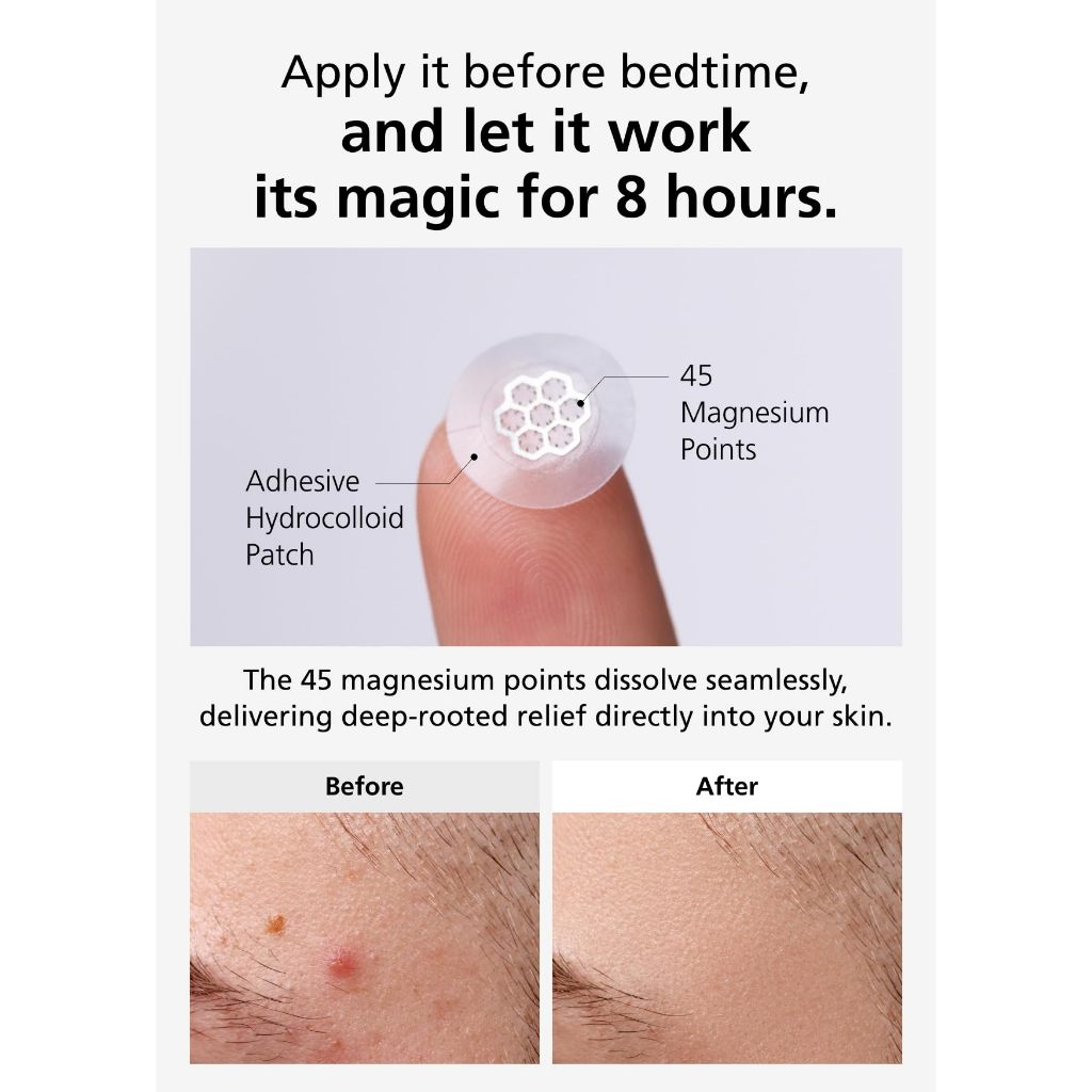 KOREA 🇰🇷 Easyderm microneedle pimple patch / hydrocolloid patch ...