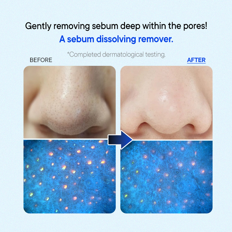 Blackhead &Sebum Removal/ Pore Cleansing/ No Pain | ONE DAY'S YOU P.Z ...