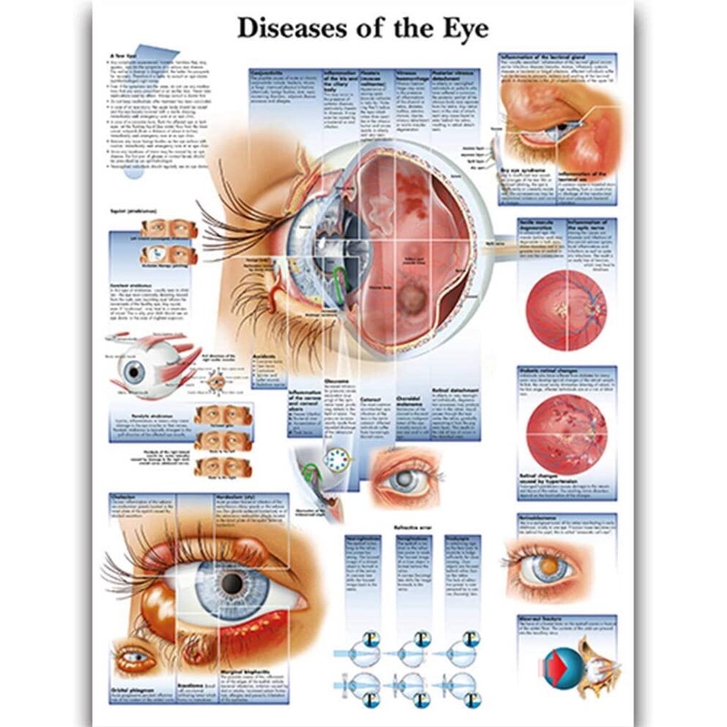 Beautiful Diseases of The Eye Anatomy Posters For Walls Nursing ...