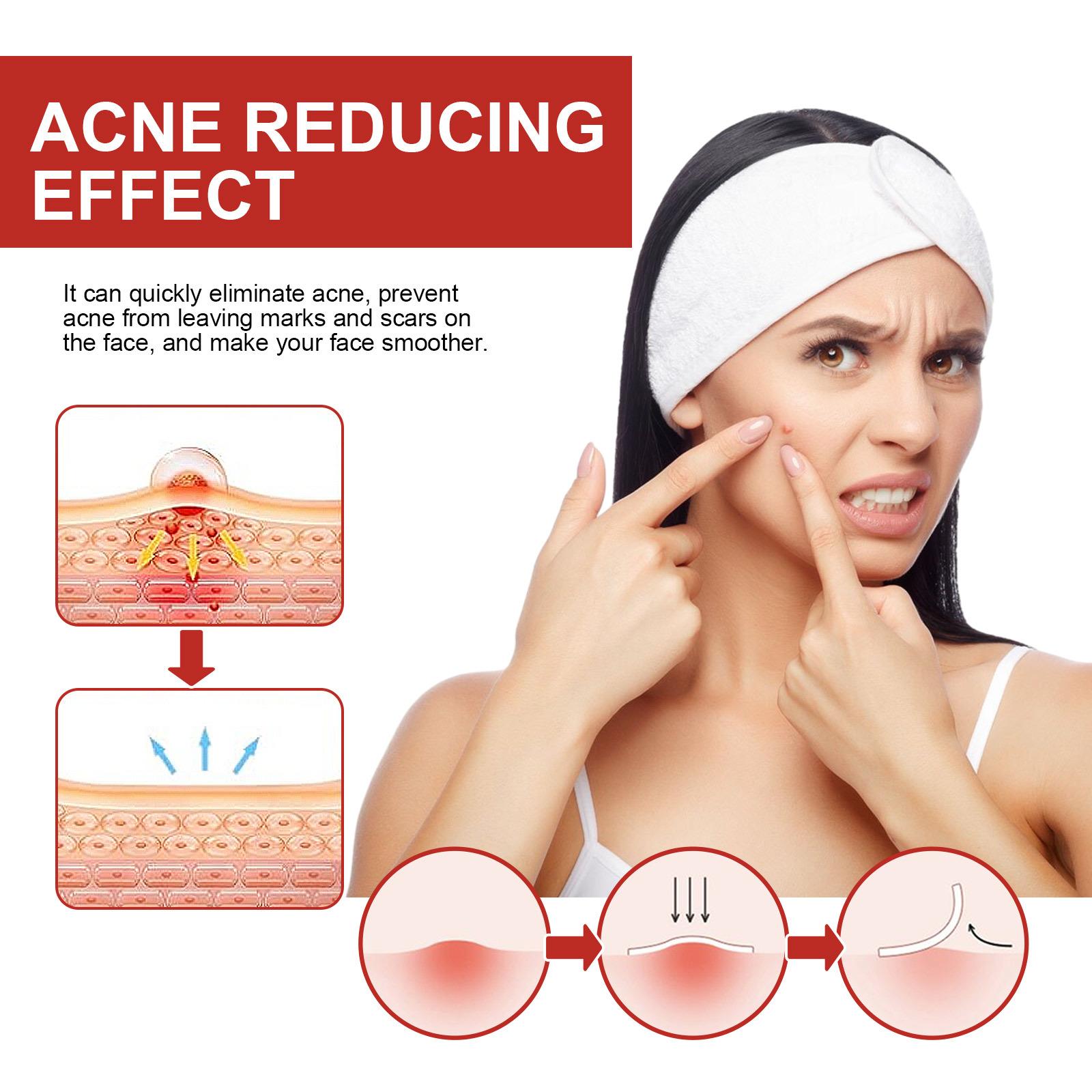 249pcs Hydrocolloid Acne Pimple Patch, Pimple Patches for Covering Zits ...