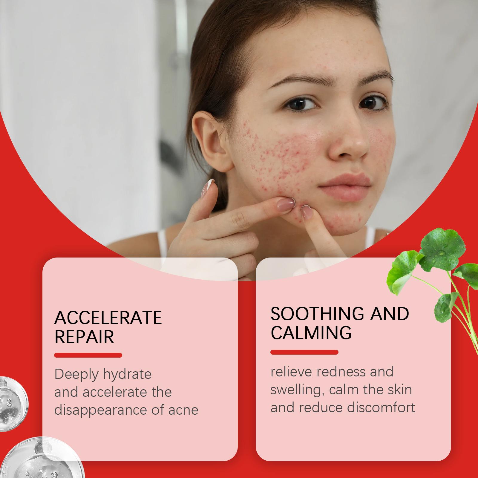 240pcs Pimple Patches for Face, Hydrocolloid Acne Pimple Patch for ...