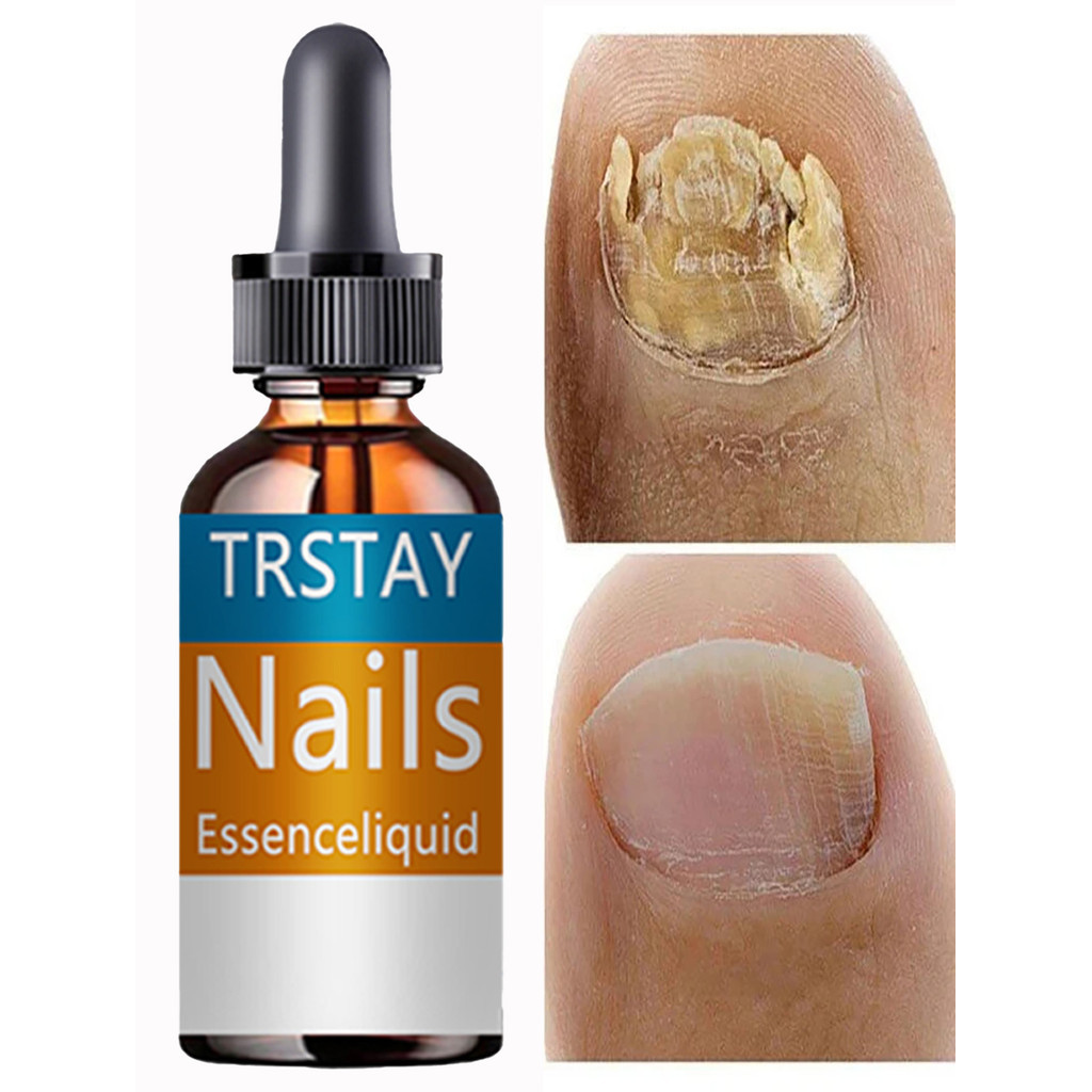 Nail Miracle: Hardening, Preventing Fragmentation, Injected With ...