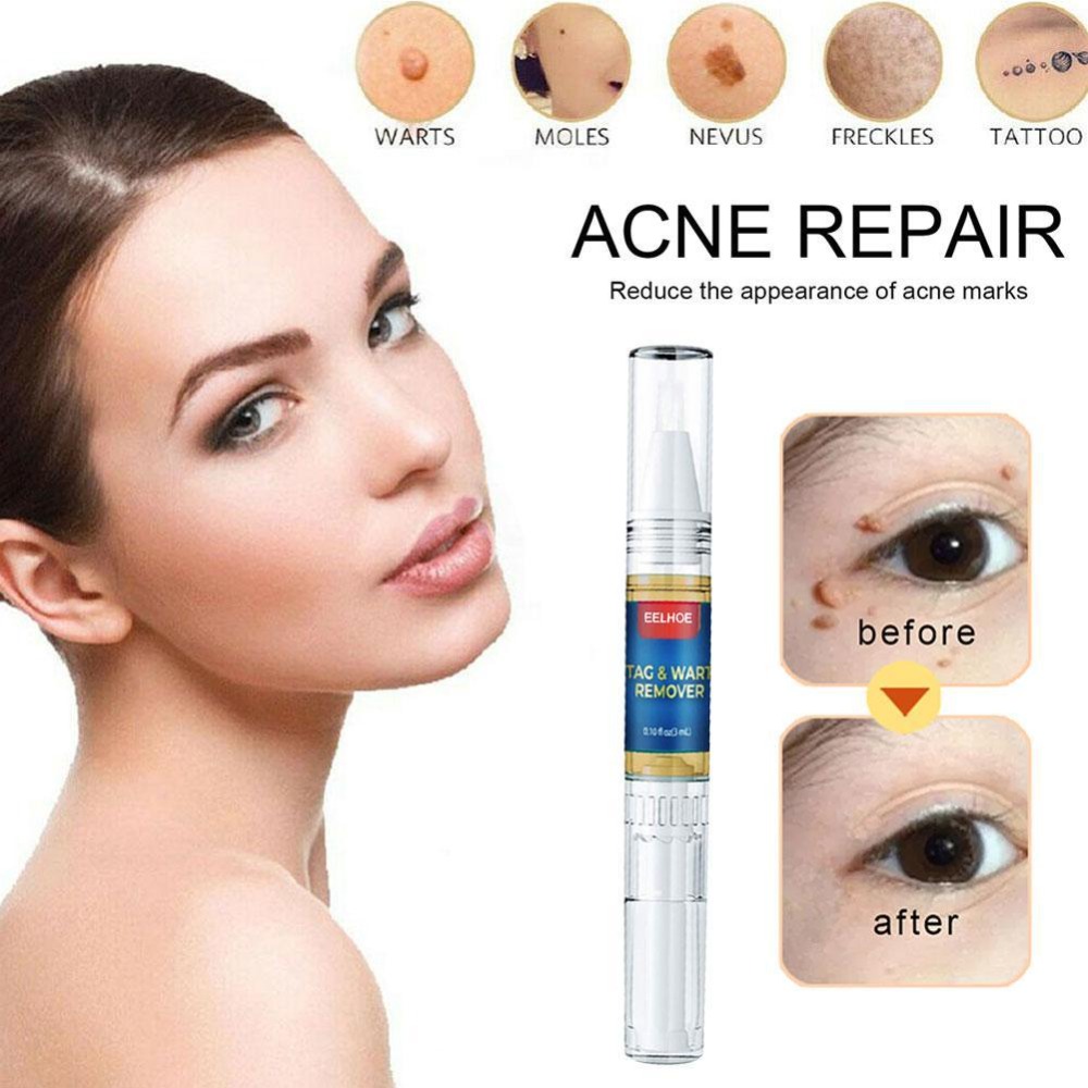 Skin Tags Removal Easy Skin Tags Warts Moles Remover Painless Skin Tags ...