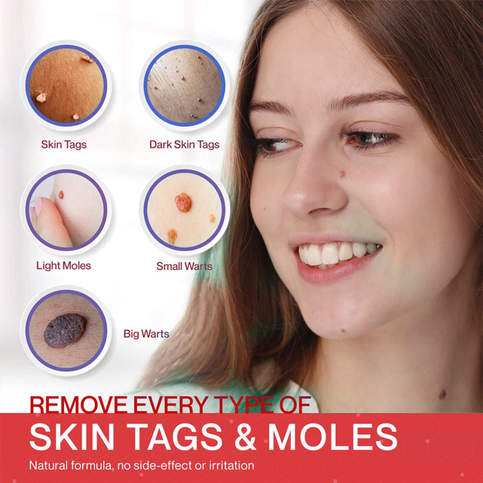 Removing Against Moles Liquid Pen Skin Tags Remover Against Papillomas ...