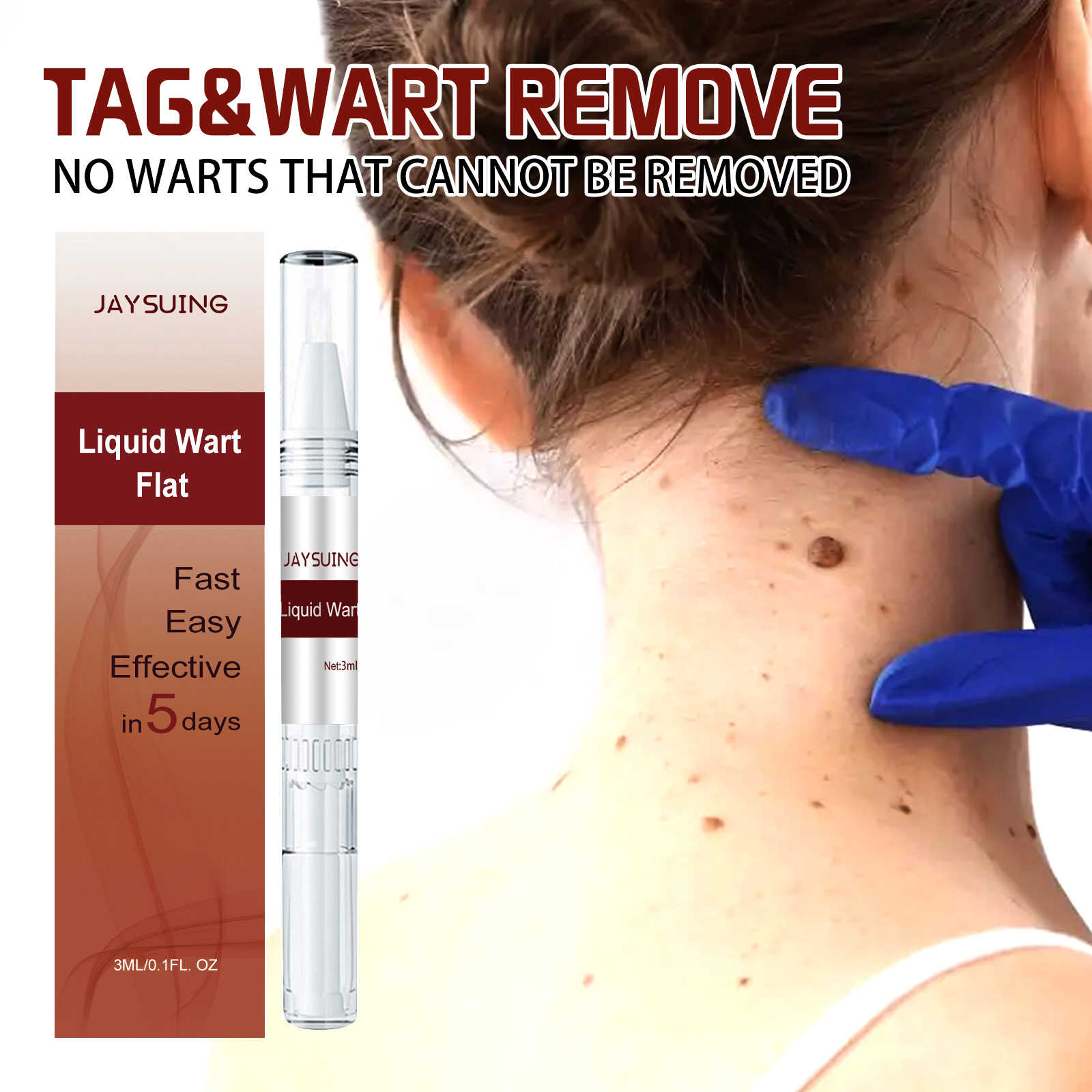 Liquid Pen for Removing Skin Tags, Moles, Papillomas, Warts, and ...