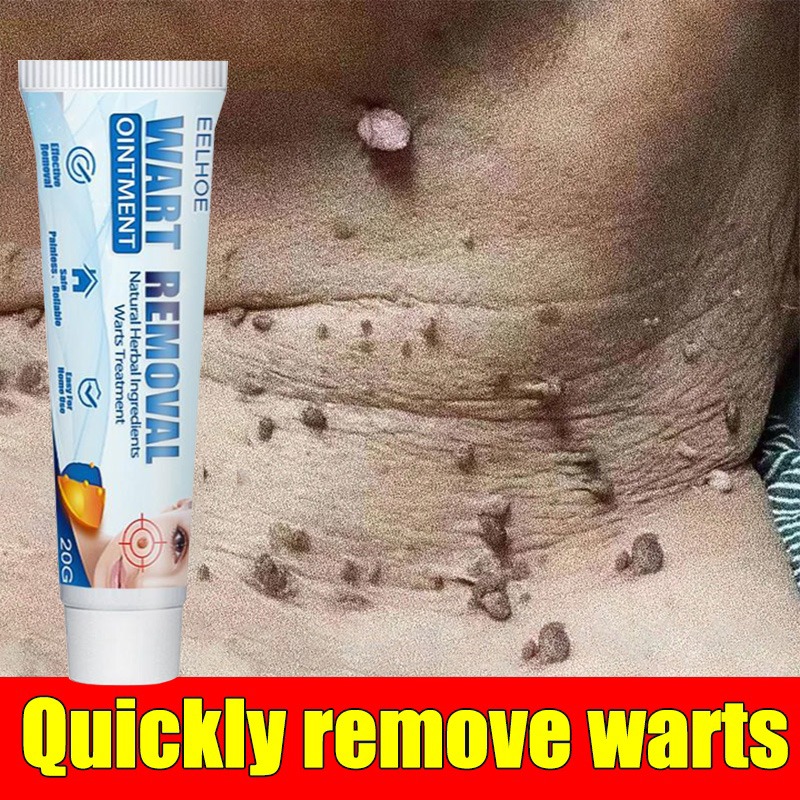 Original Ointment for Wart Removal, Skin Tags, and Marks 20g Krim Buang ...