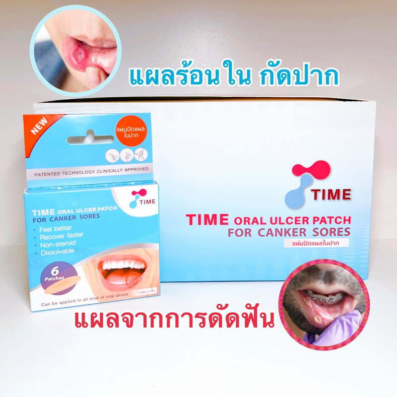 Time Oral Ulcer Patch 6 Sheets Of Mouth Ulcers. | Shopee Malaysia
