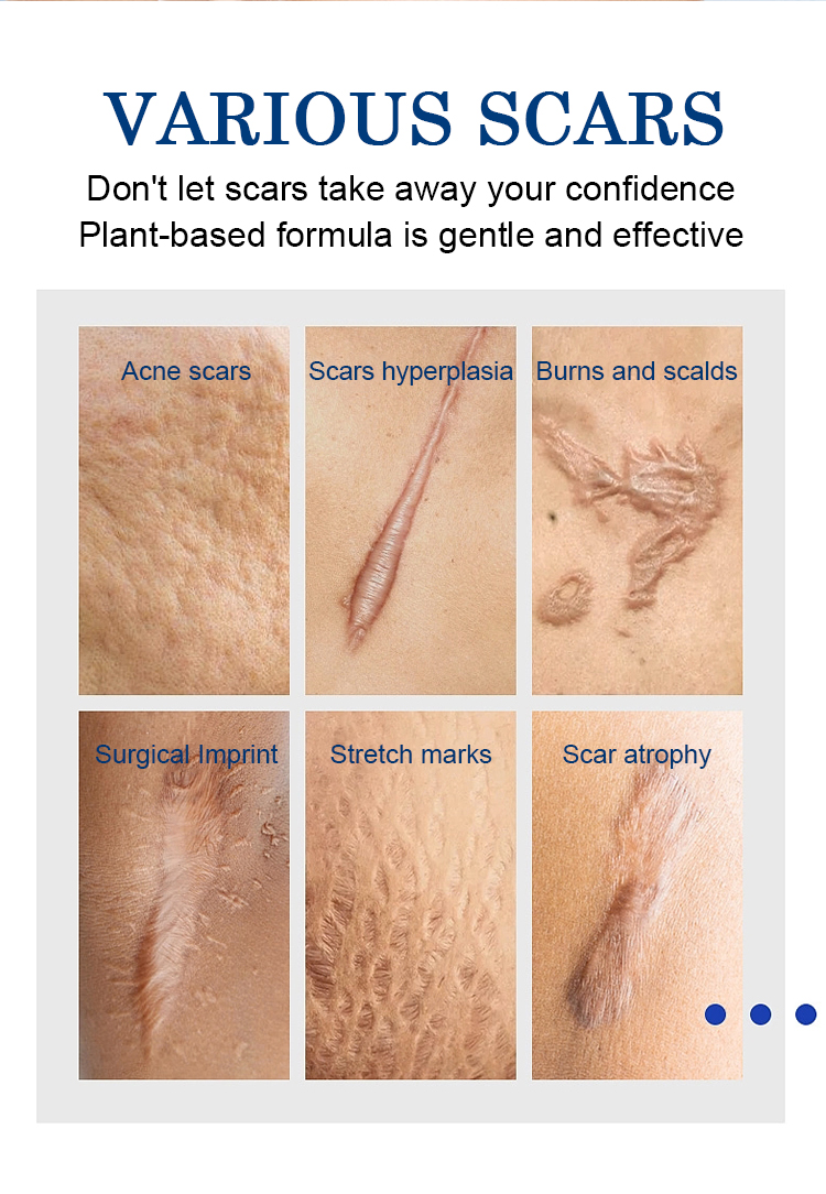 MOOYAM Anti-Scar Cream Scar Removal Facial And Body Scars Repair Gel ...