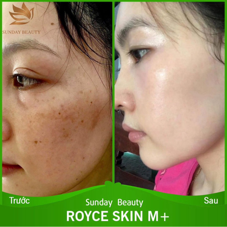 [SKIN Peel] ROYCE SKIN M+ SKIN peel A22 Satellite Standard Biological ...