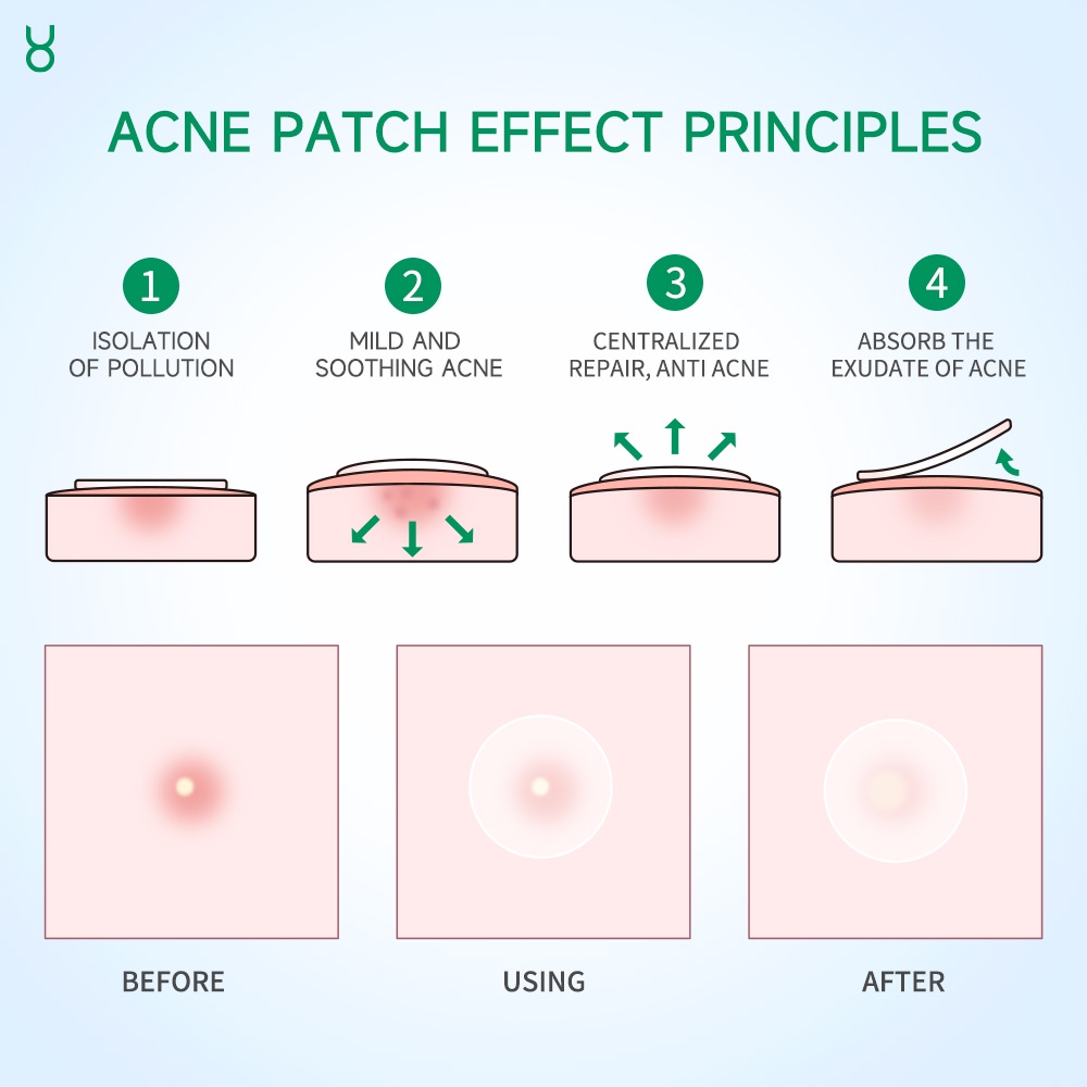 Focalskin Waterproof Oil-control Invisible Acne Patch Day And Night ...