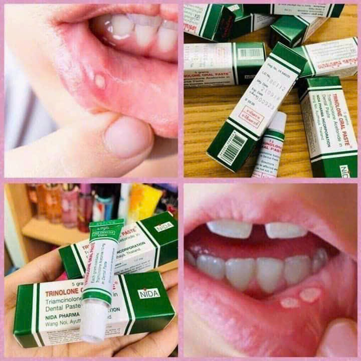 Thai mouth ulcer cream | Shopee Malaysia