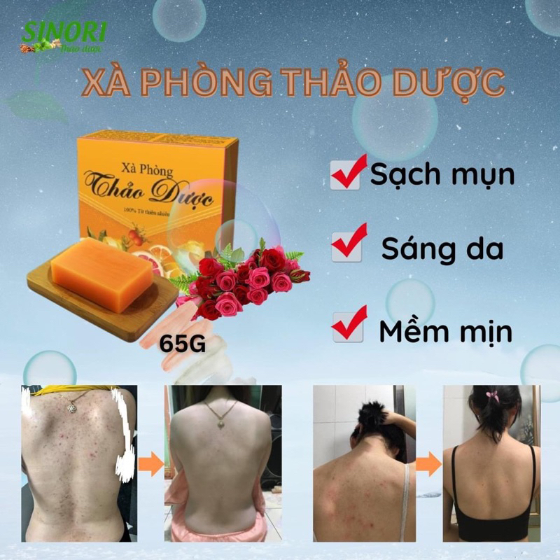 Sinori Herbal Soap 65g - Get Rid Of Back Acne, Folliculitis, Dead Skin ...