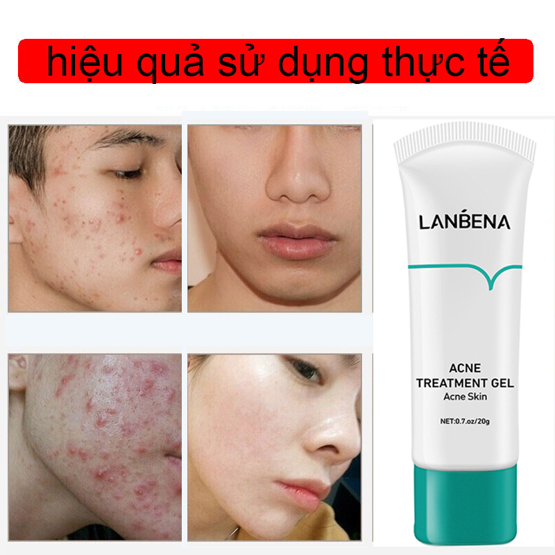 Moisturizing Acne Cream Brightens Smooth Skin For Inflammatory Acne ...