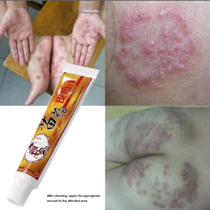Chinese oriental medicine dermatological cream reduces itching, eczema ...