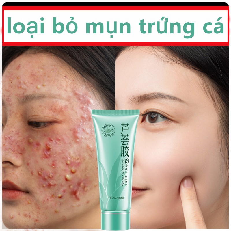 Aloe vera Gel Aloe Vera Gel Acne Cream 40g fades dark spots and scars ...