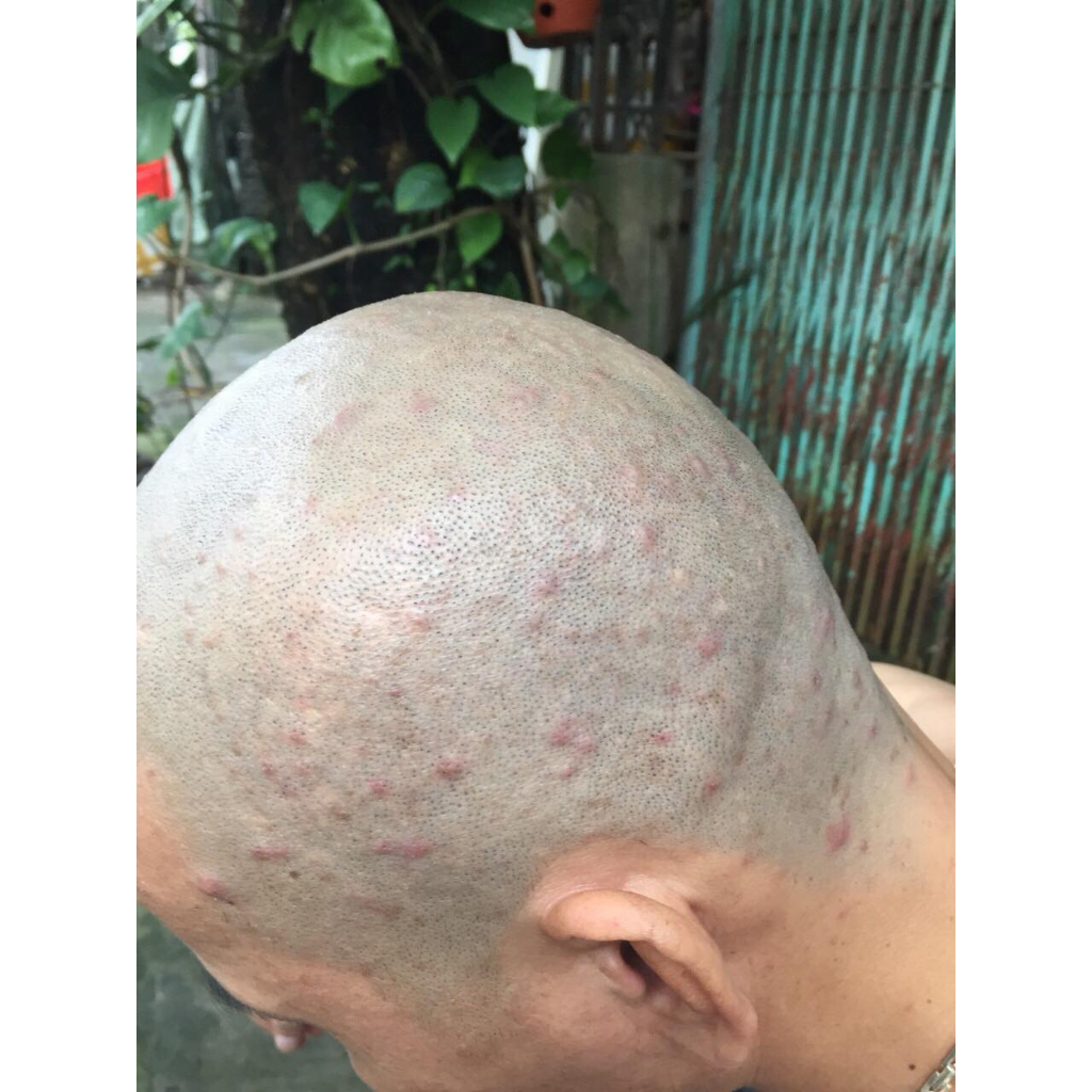 Herbal Clear Scalp Fungus _ Scalp Psoriasis (Scalp Psoriasis, Peeling ...