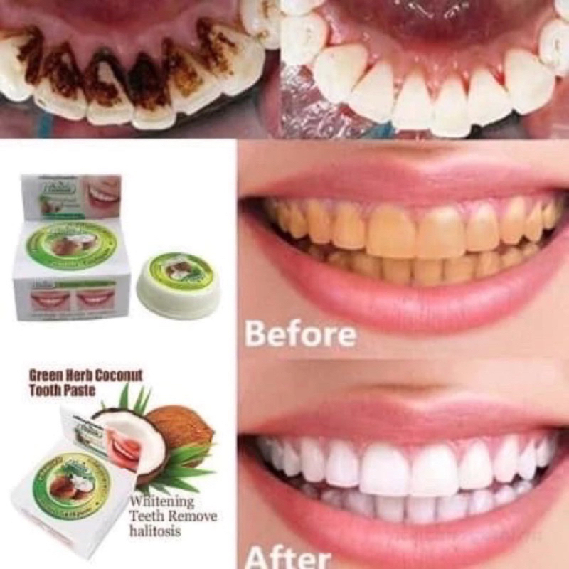 Thai teeth whitening cream, Good prevention of gum problems, plaque ...