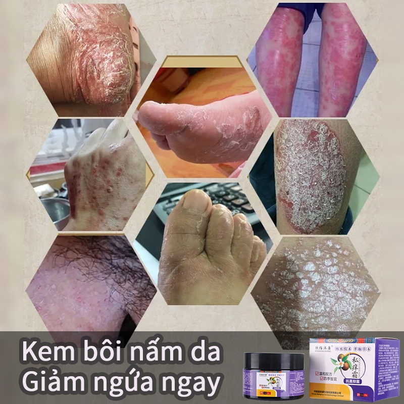 Tengzhong topical cream improves psoriasis, keratosis and atopic ...