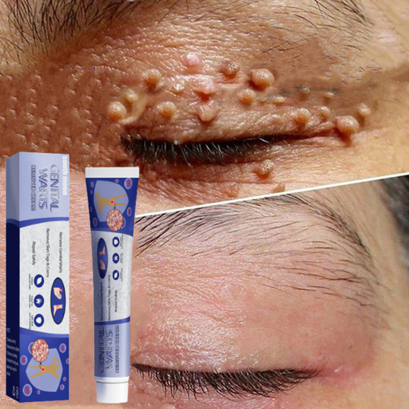 Wart removal cream 20g, skin tags, removes common warts, stones, warts ...