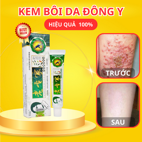 Itchy Fungus Topical Cream Supports Ringworm, Dyshidrosis, Psoriasis ...