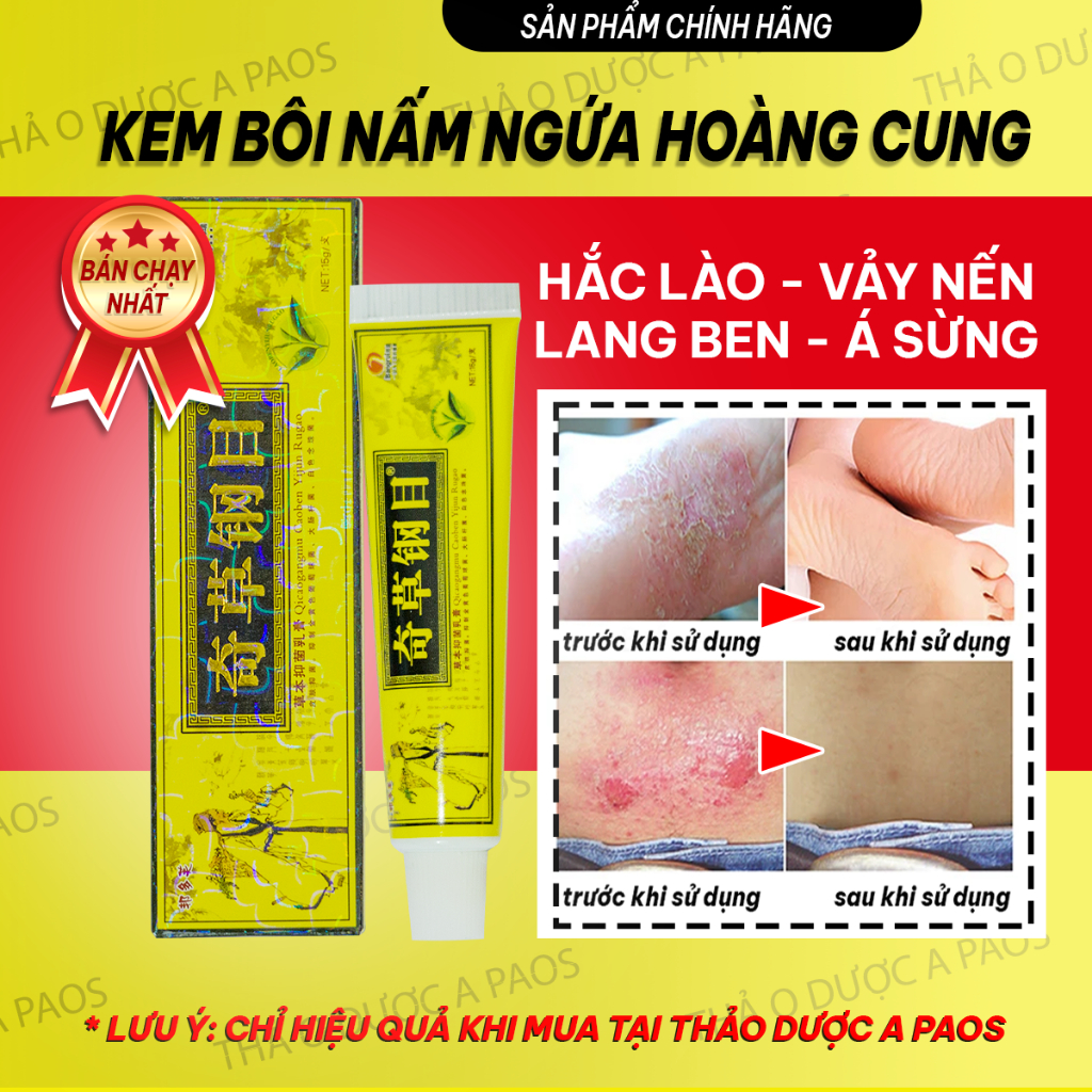 Itchy Fungus Cream, Royal Mushroom Cream, Ringworm, Urticaria ...