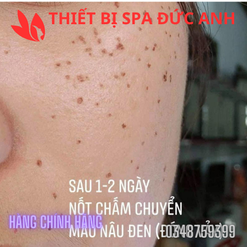 Tca Spots Freckles Pitting Scars Mole Deep Spots Mole Reduce Melamine ...