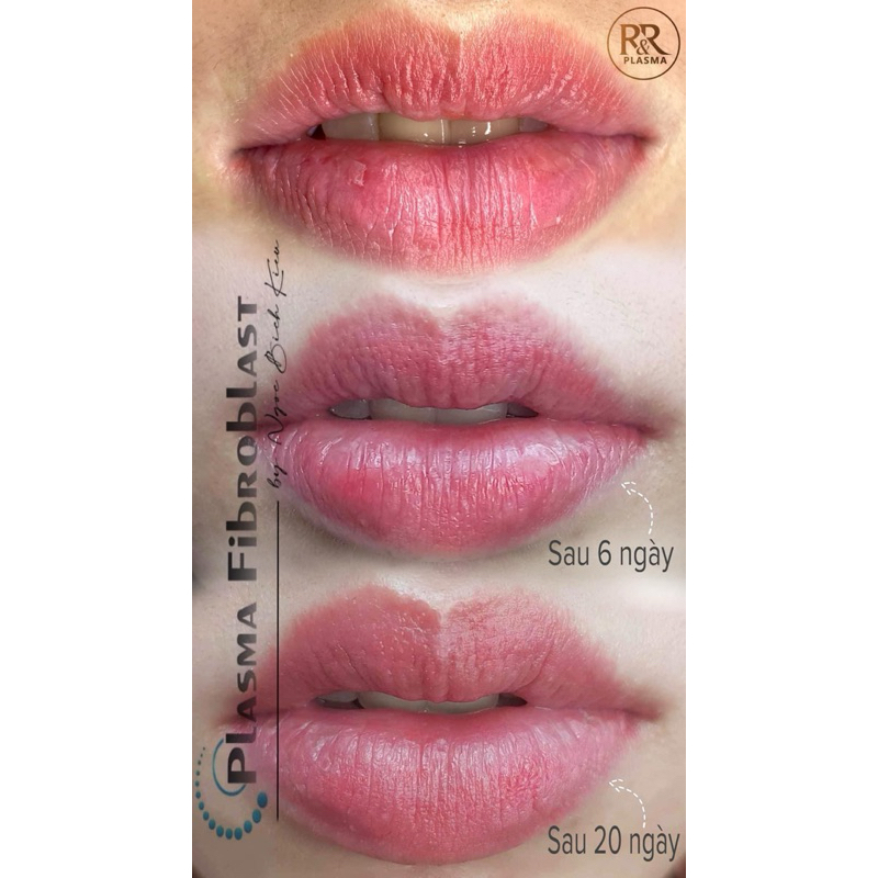 (Lip Melasma in District 3 HCM) Lip Rejuvenation/ Ink residue removal ...
