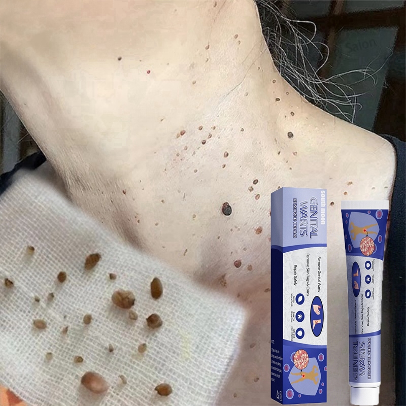 Wart cream 20g Mole removal cream Mole removal Gel, warts, skin tags ...