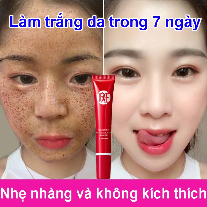 Freckle Slingshotm cream, Freckle removal cream, Facial whitening cream ...