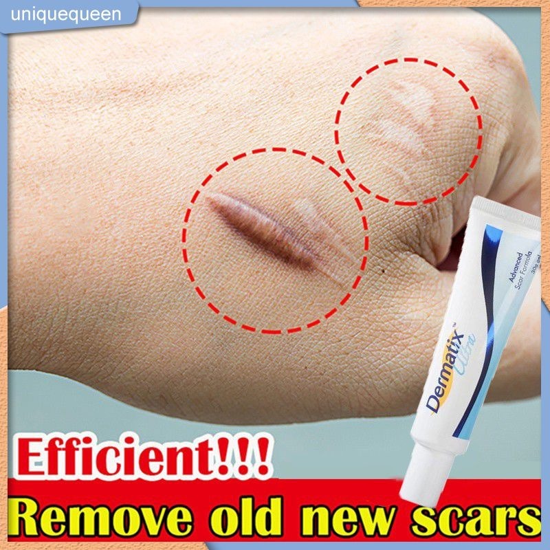 DERMATIX [HCM]Dermatex Ultra cream helps flatten and soften keloid ...