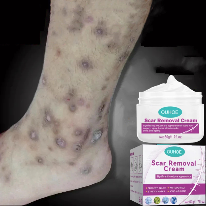 Scar Fade Cream Dark Scars Due to Wound Scars Burn Scars Surgical Scars ...