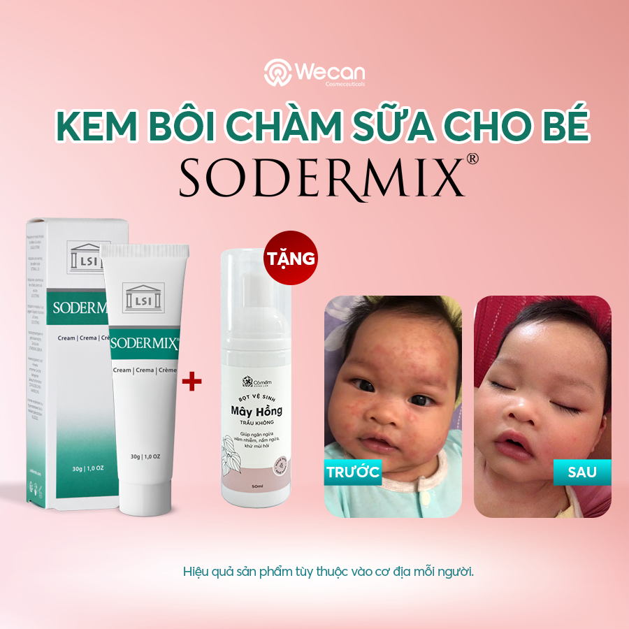 Sodermix Milk Eczema Cream 30g - Free Pink Cloud for Mom - Helps Reduce ...