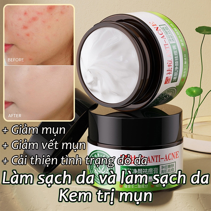 Acne cream 30g Acne cream removes all types of acne Cleans skin ...