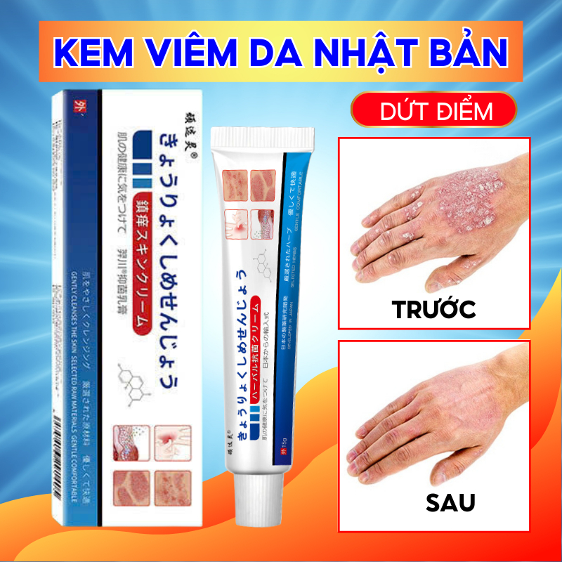 Effective Cream for Itchy Fungus, Atopic Dermatitis, Ringworm ...