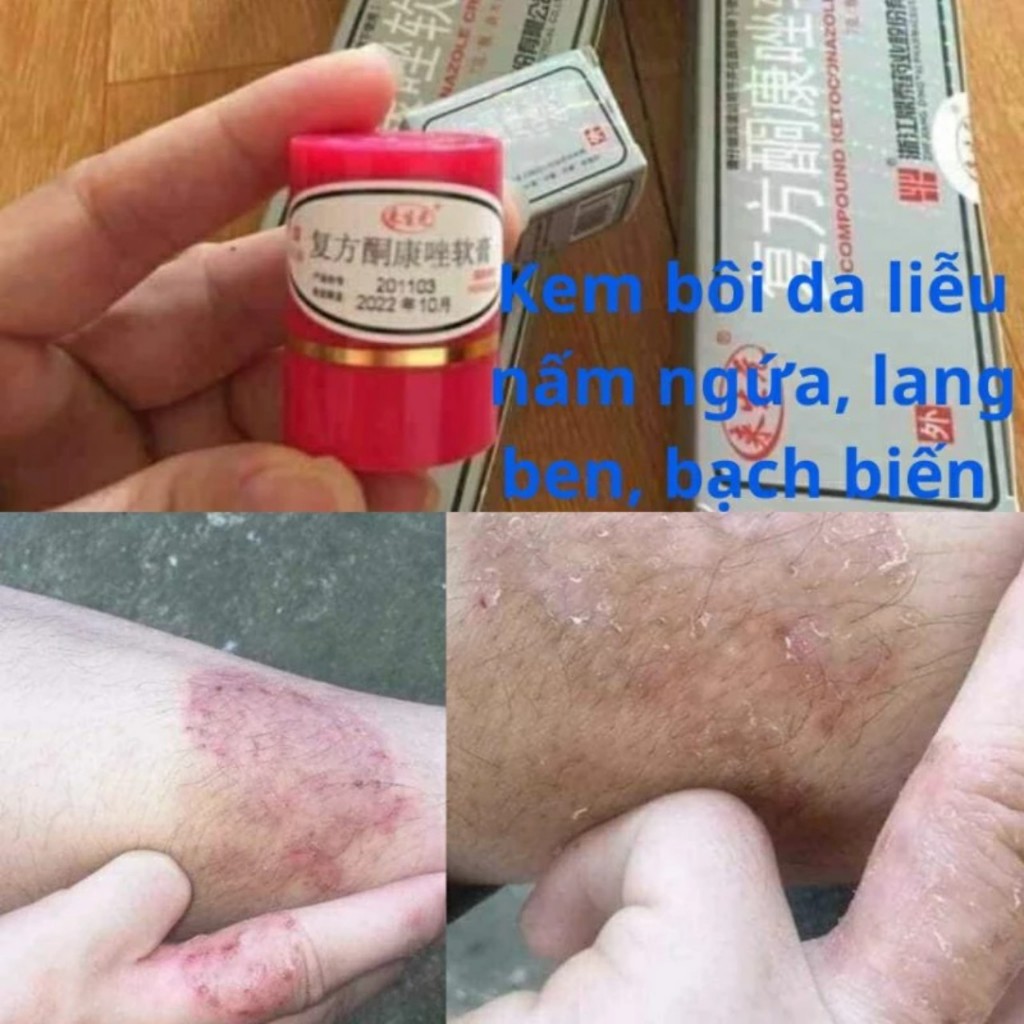 5 bottles of skin cream for itchy fungus, hives, ringworm, dyshidrosis ...