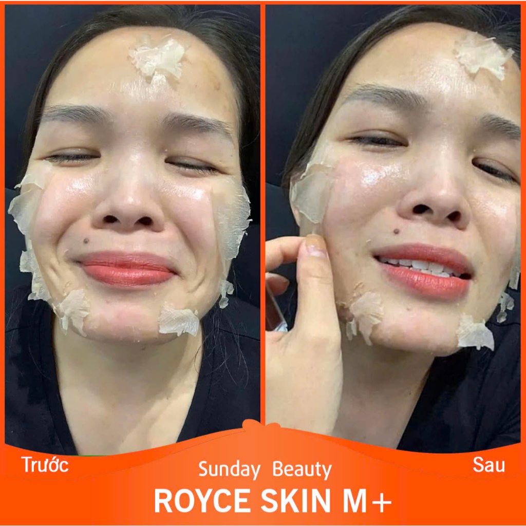 [SKIN Peel] ROYCE SKIN m+ SKIN Peel, peeling off large patches, peeling ...