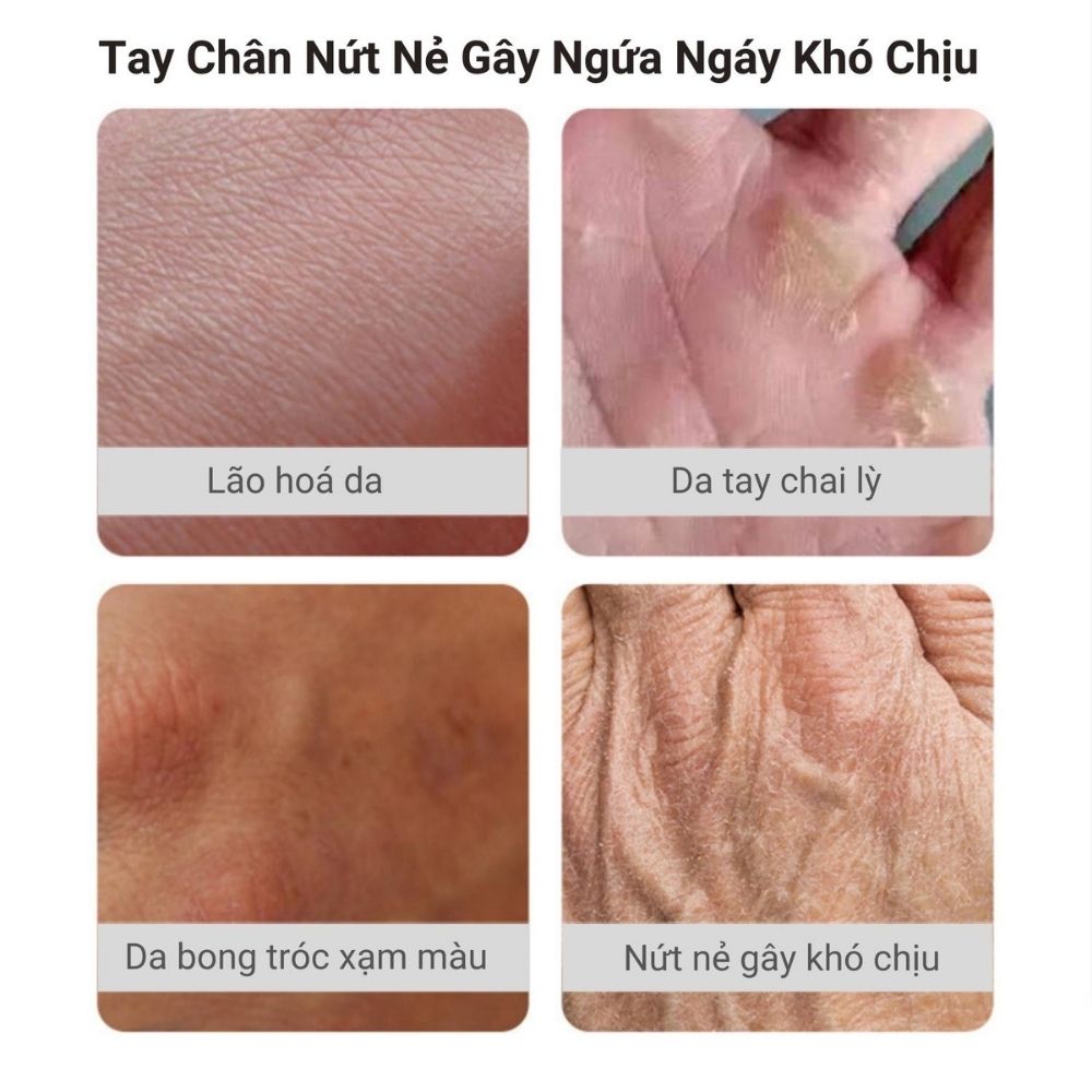 Heel Chapped Cream With Rough Skin Regeneration Prevention Cream 20g ...