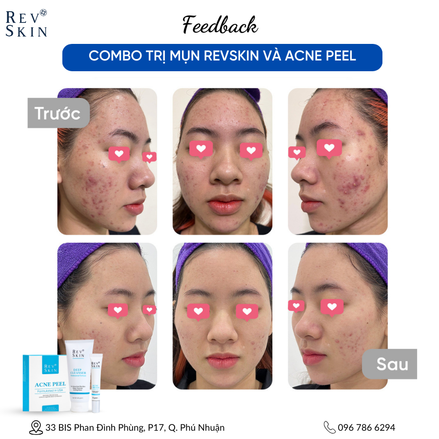 Acne Peel Set - Acne Peel removes pustules, horns, inflammatory Acne ...