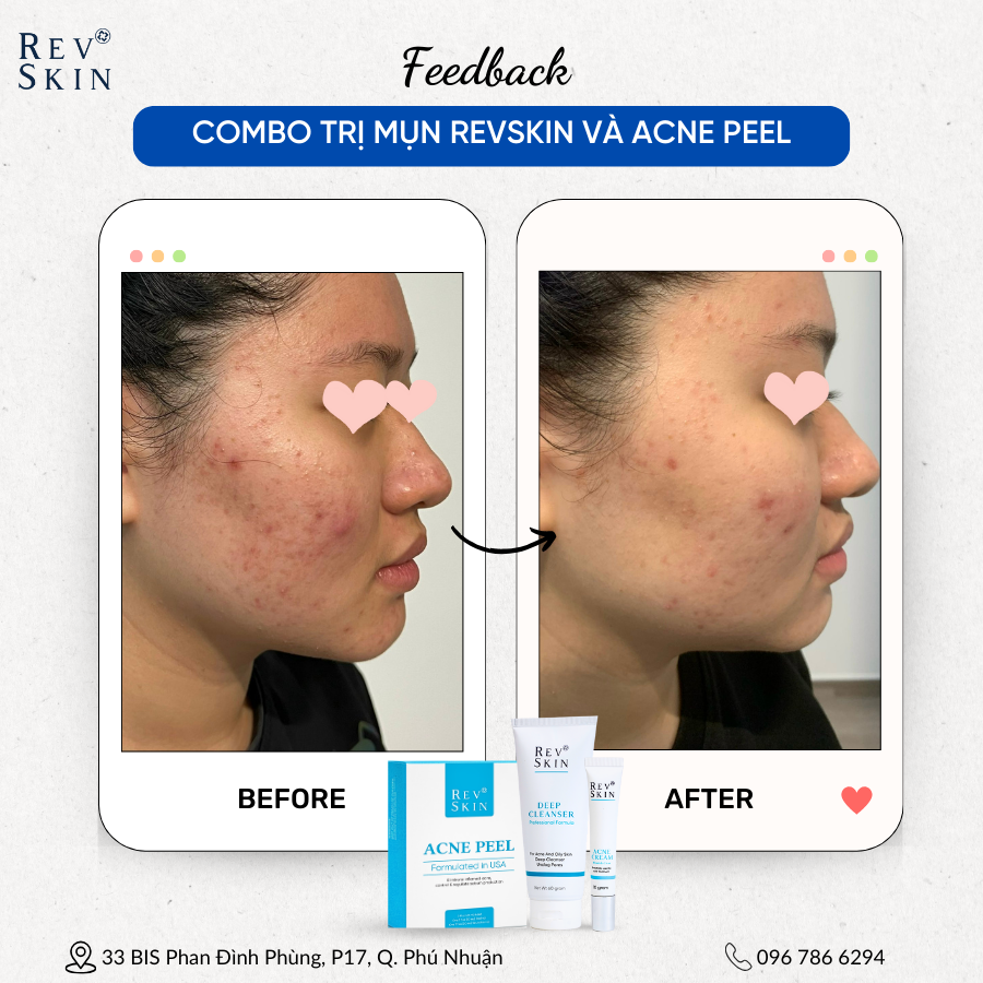 Acne Peel Set - Acne Peel removes pustules, horns, inflammatory Acne ...