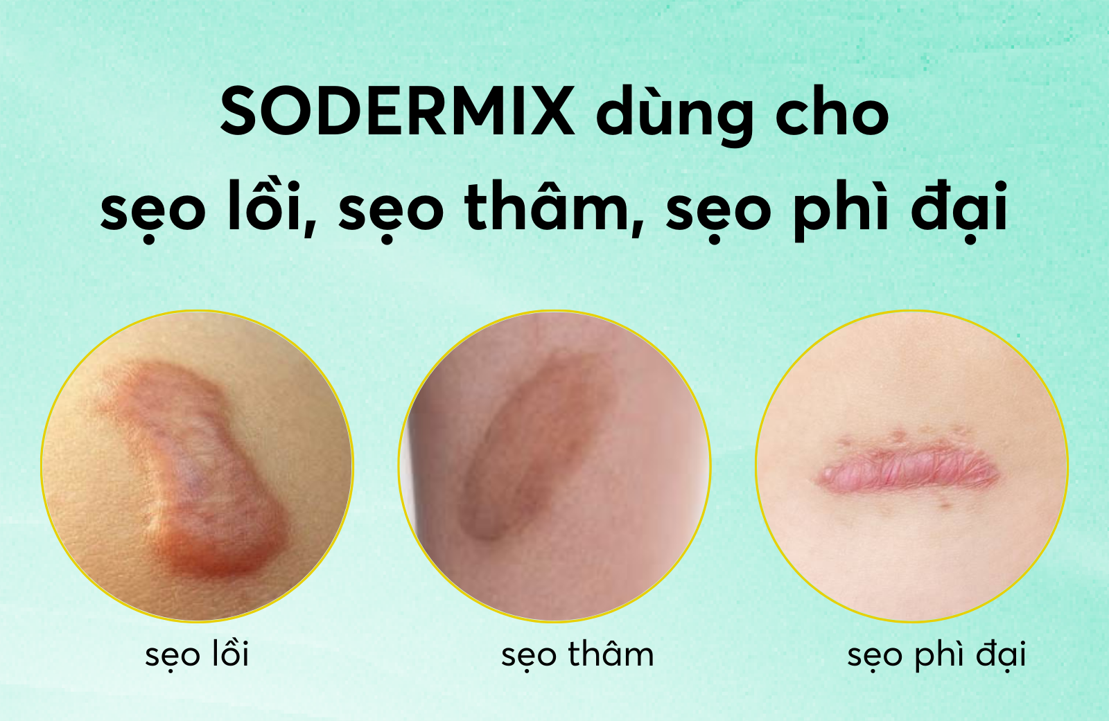 Keloid and Hypertrophic Scar Cream - SODERMIX - Supports the Reduction ...