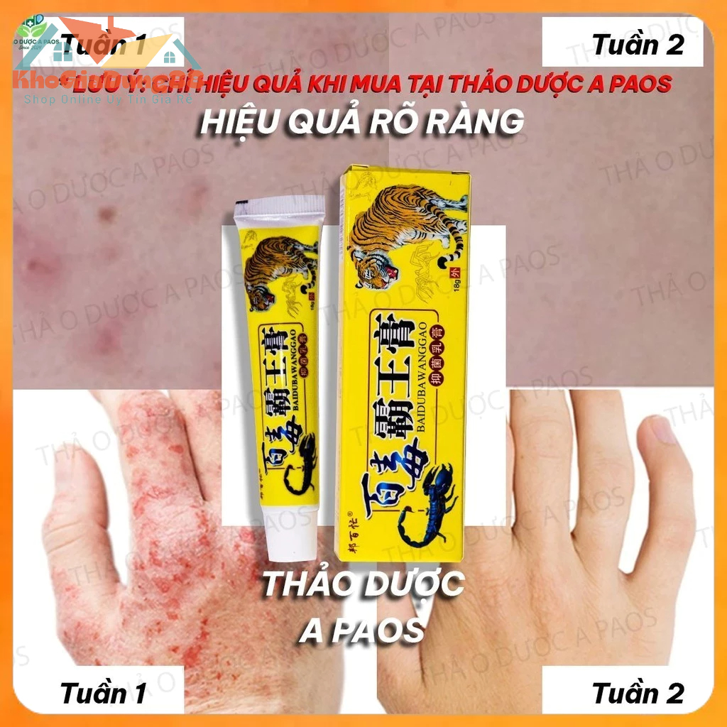 Zebra anti-fungal cream specializes in treating ringworm, itchy fungus ...